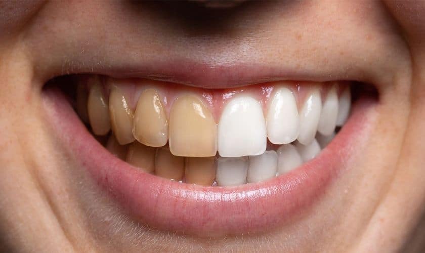 5 Easy Ways To Get Rid Of Coffee Stains On Your Teeth 5 Easy Ways To Get Rid Of Coffee Stains On Your Teeth